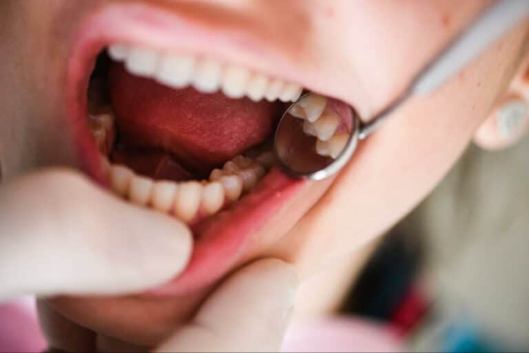 Agenesia dental: qué es, tipos, causas y tratamiento